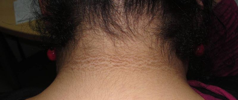 Conoce un poco más sobre la Acantosis Nigricans|Causas y síntomas ...